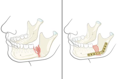 Face & Jaw Trauma - Dr. Deys Dental & Maxillofacial Center